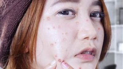 How To Improve Pitted Scars? | Wrytin